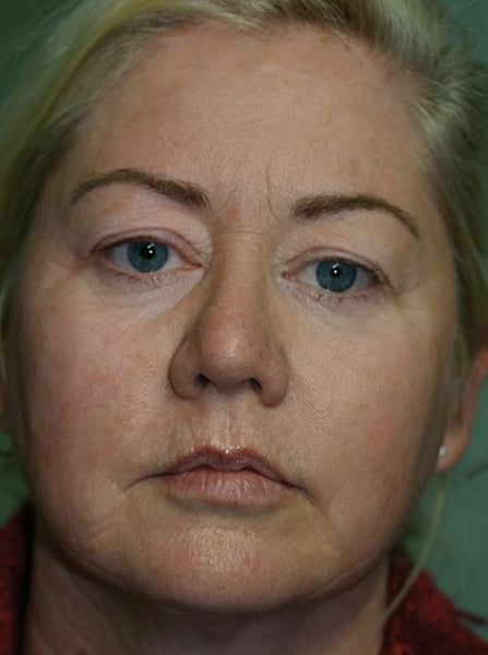 Sun damage repair | Skin Clinic, Australia