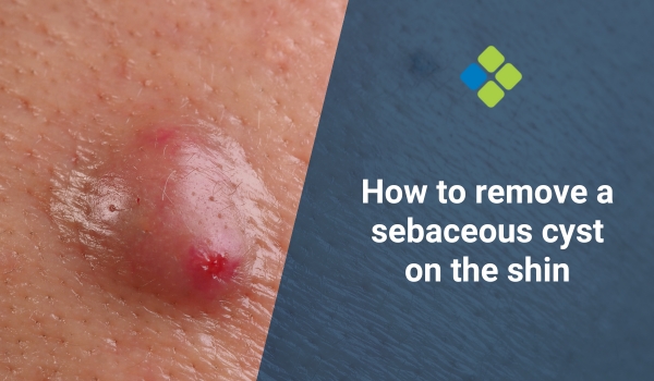 Subcutaneous Cyst Sebaceous Cysts: Causes, Diagnosis, And Treatment