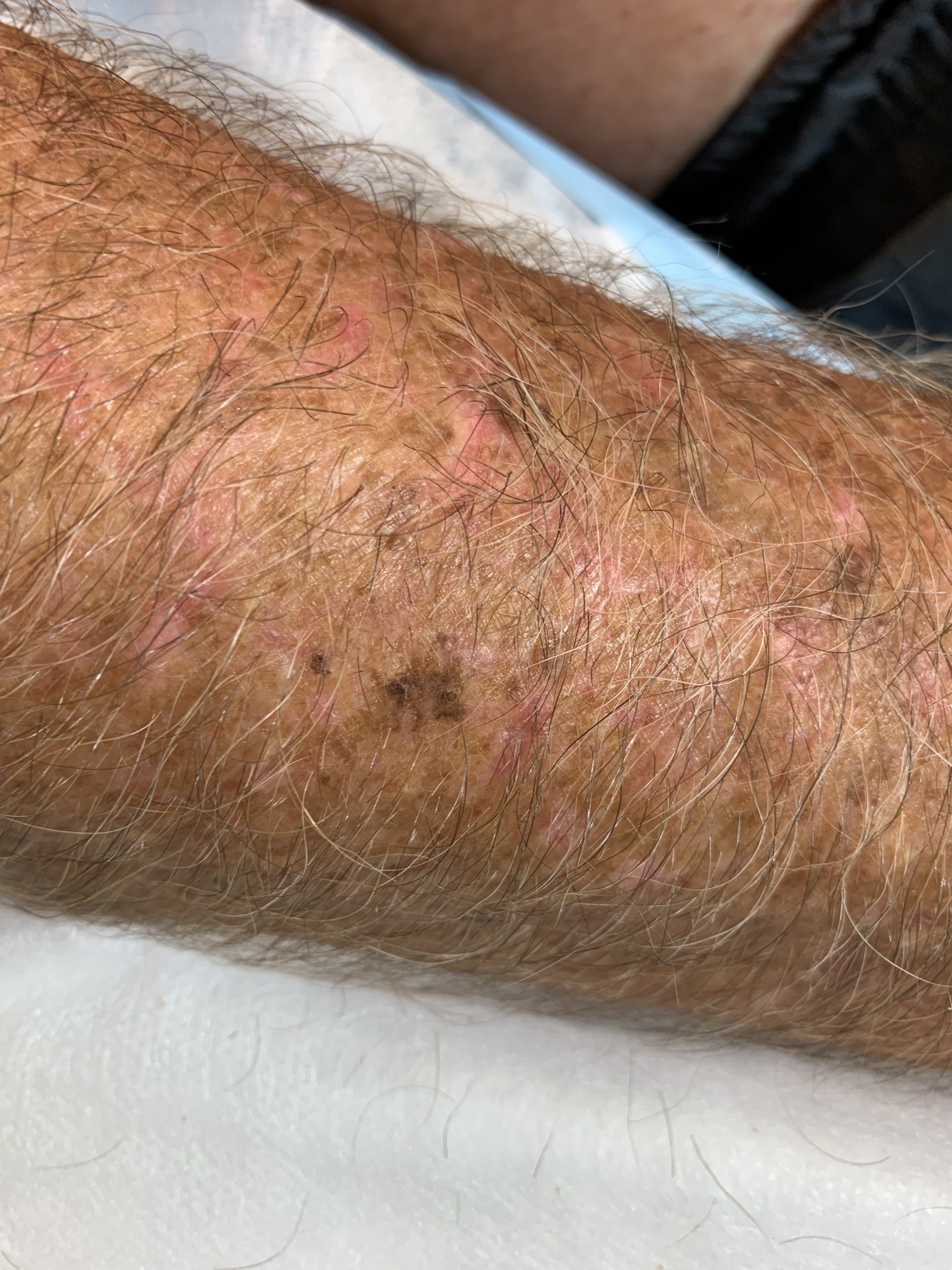 Skin Cancer On Forearm