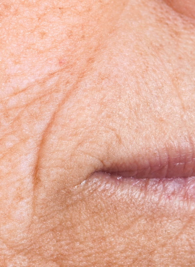 Non-ablative laser therapies | National Skin Cancer Centres